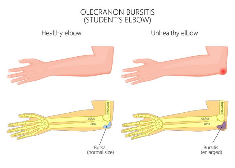 What Exactly Is Elbow (Olecranon) Bursitis? - SimplyJnJ